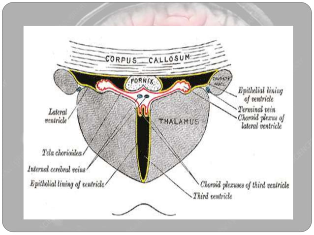 Colloid cyst | PPTX | Brain and Nervous System Disorders | Diseases and ...