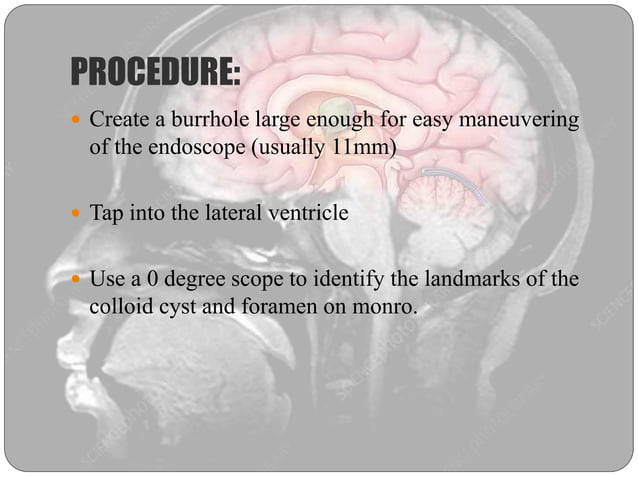 Colloid cyst | PPTX | Brain and Nervous System Disorders | Diseases and ...