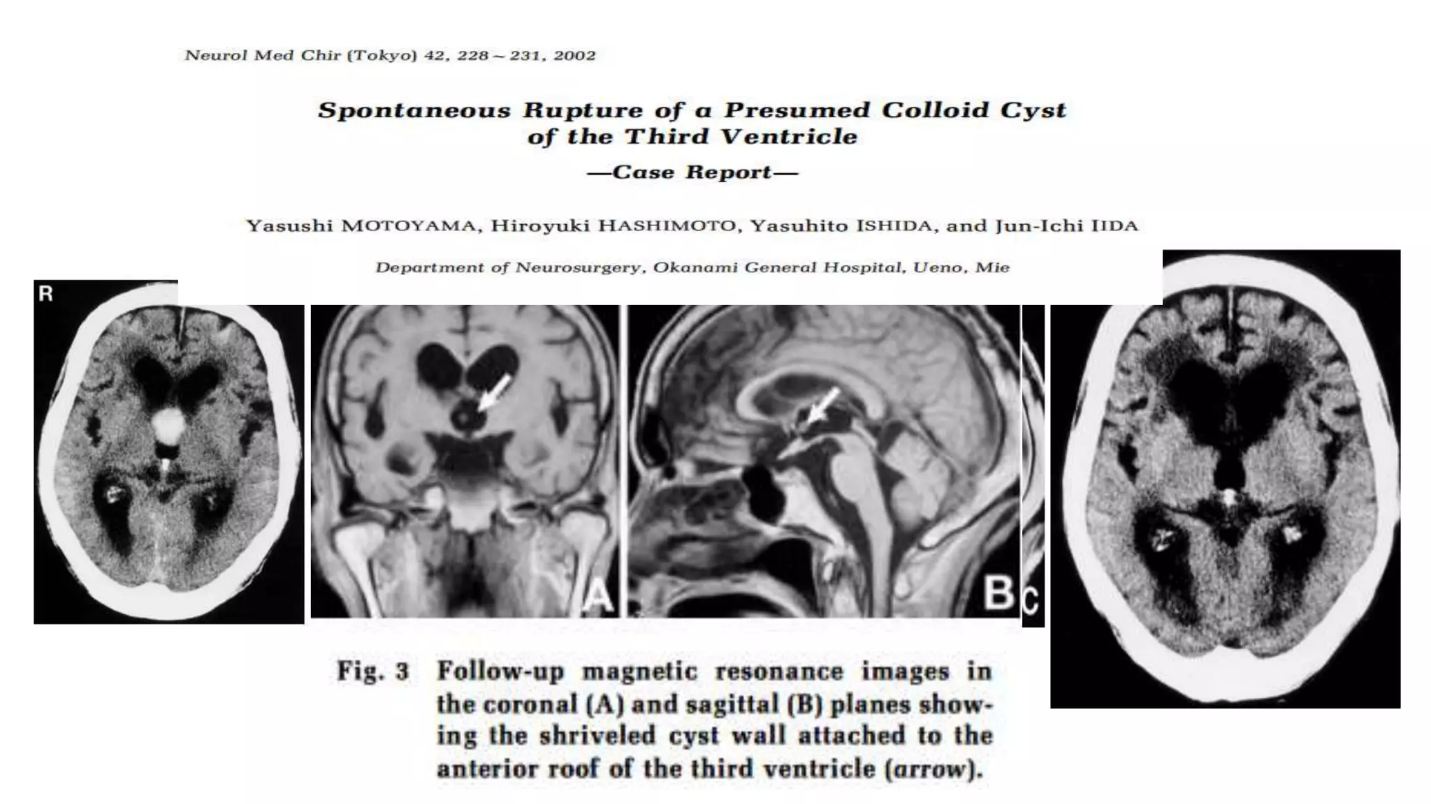COLLOID CYST OF THE THIRD VENTRICLE .PPTX