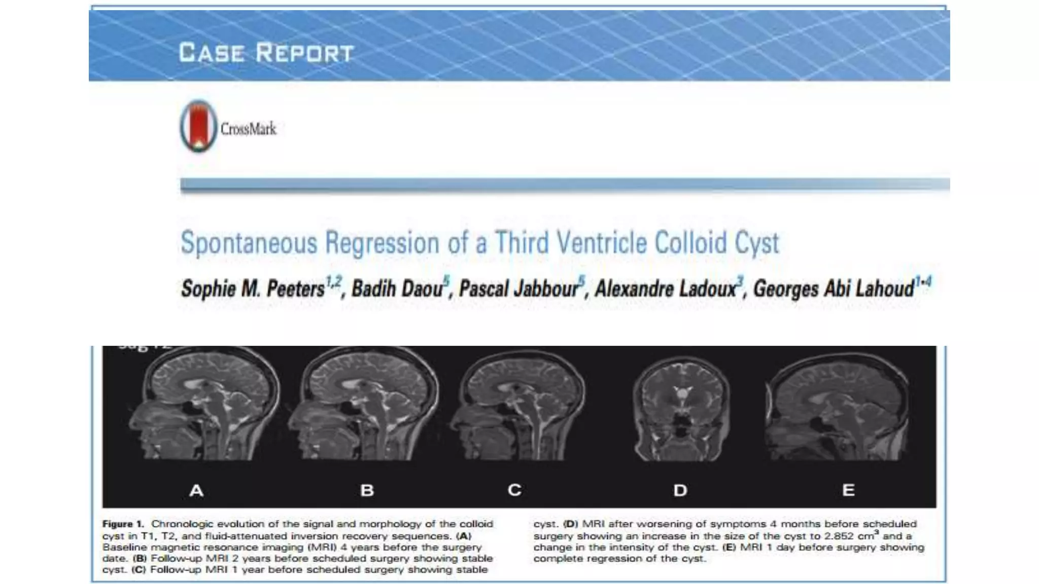 COLLOID CYST OF THE THIRD VENTRICLE .PPTX