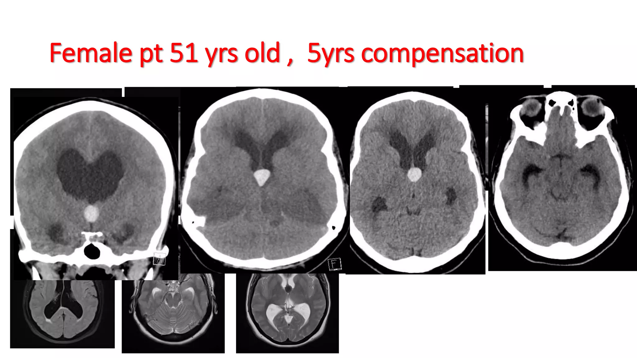 COLLOID CYST OF THE THIRD VENTRICLE .PPTX