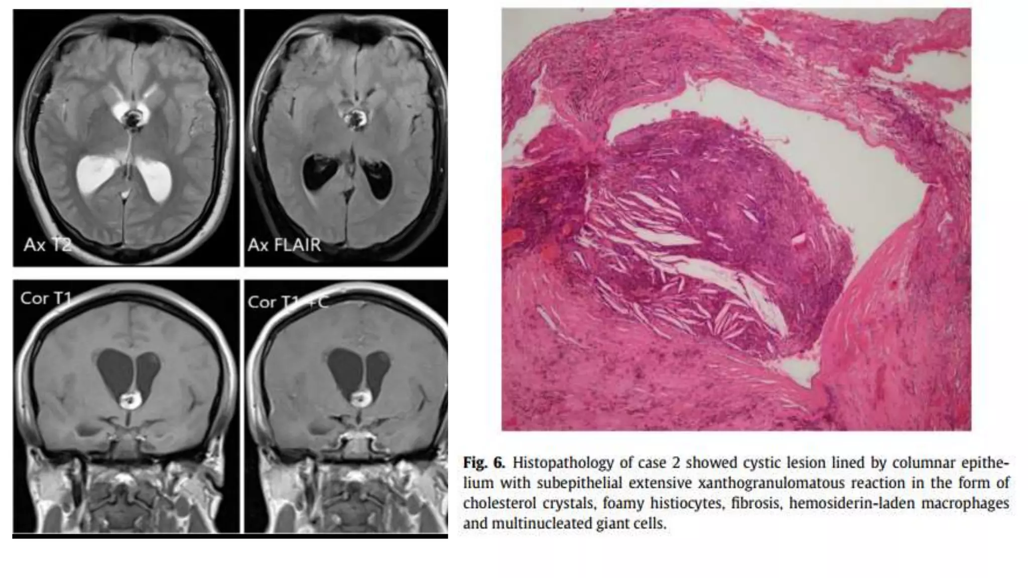 COLLOID CYST OF THE THIRD VENTRICLE .PPTX
