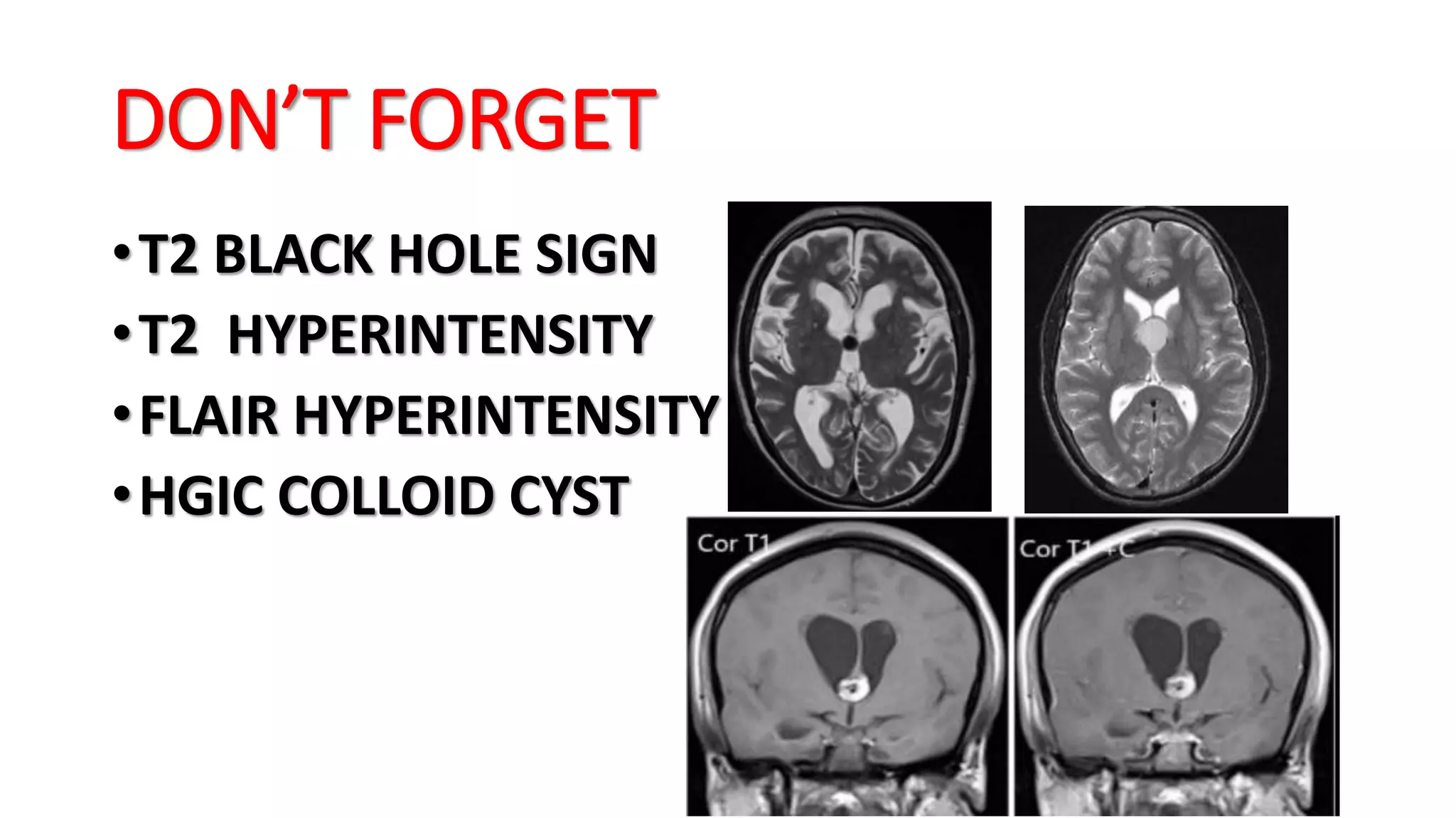 COLLOID CYST OF THE THIRD VENTRICLE .PPTX