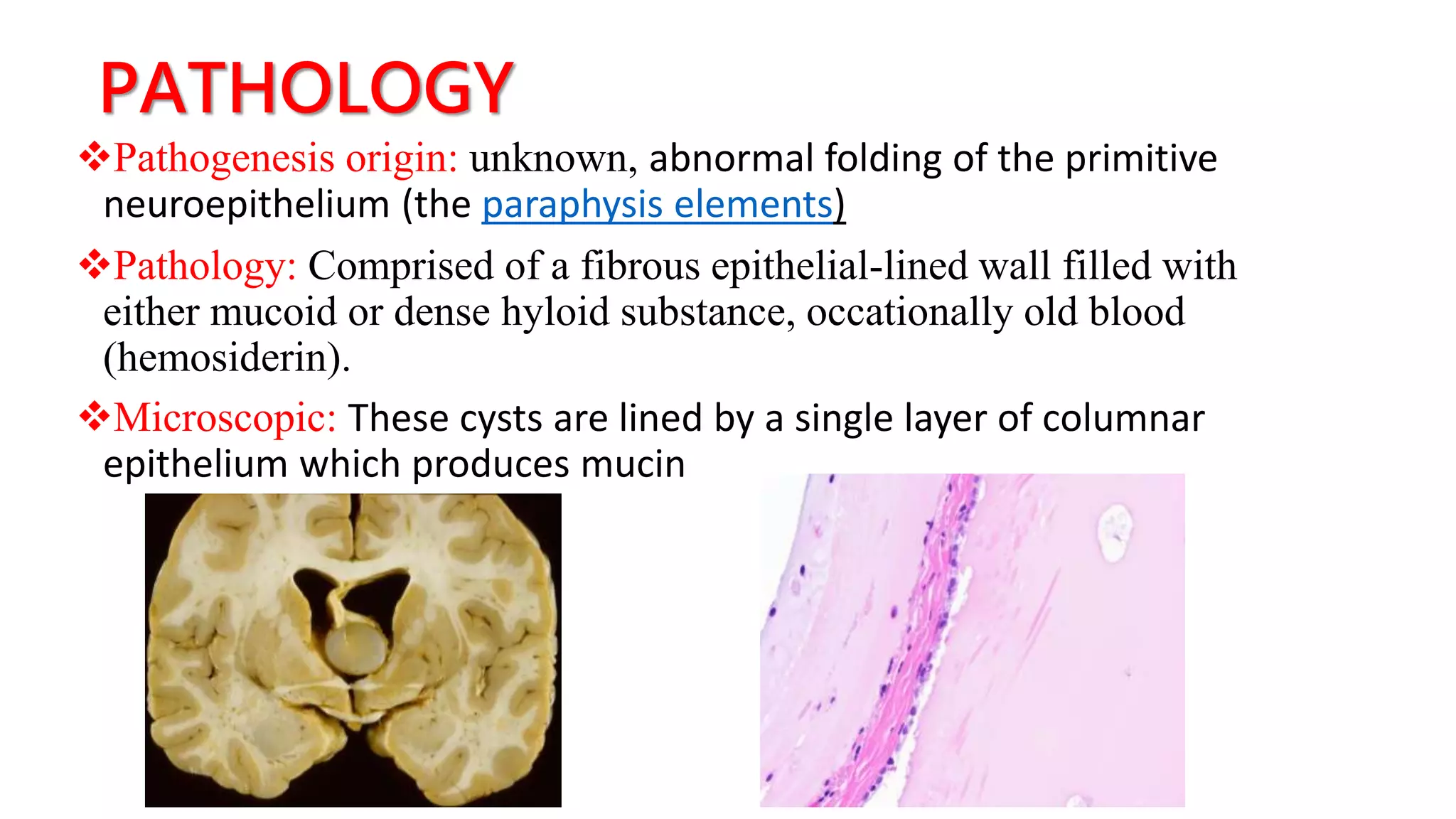 COLLOID CYST OF THE THIRD VENTRICLE .PPTX