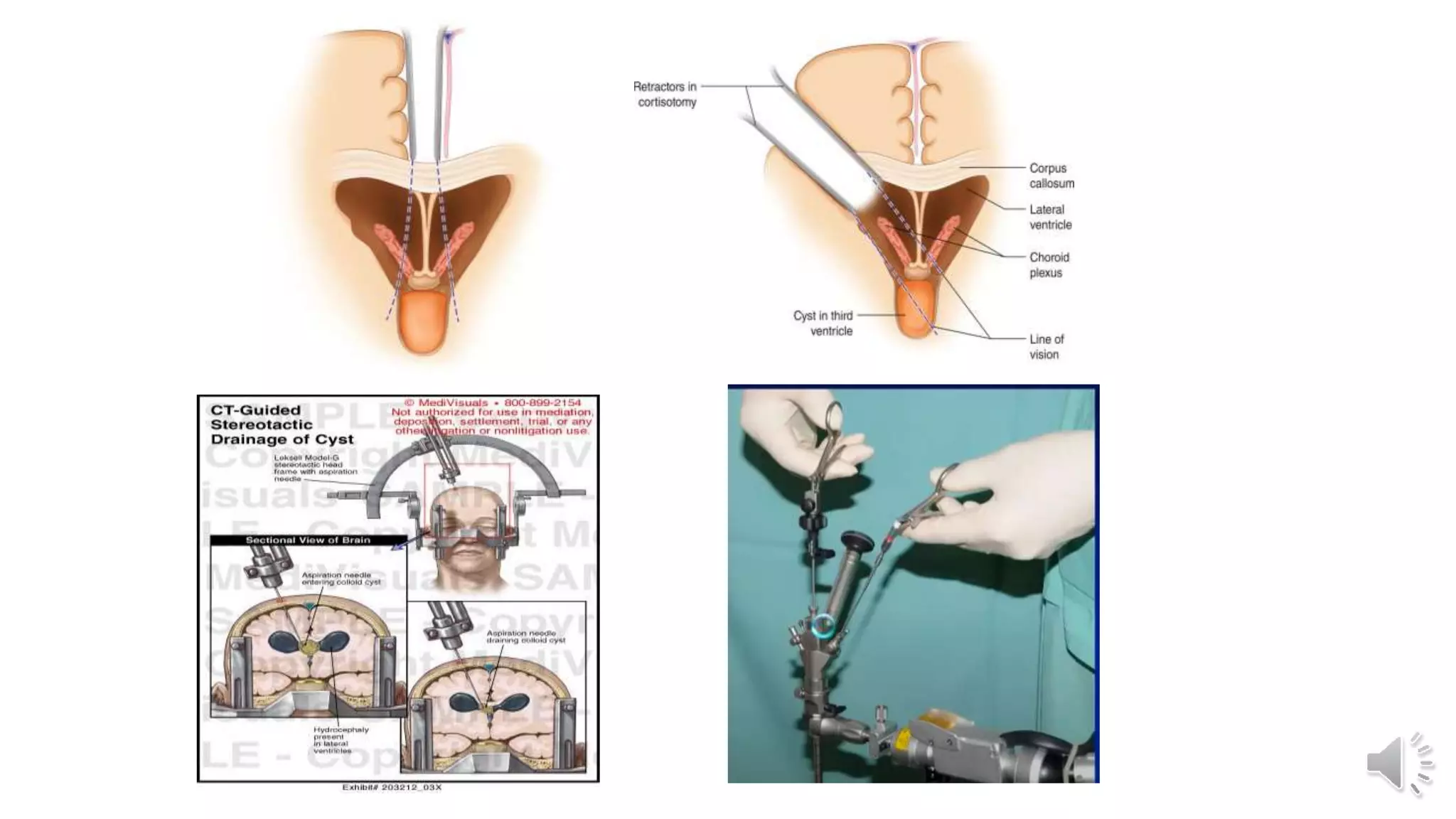 COLLOID CYST OF THE THIRD VENTRICLE .PPTX