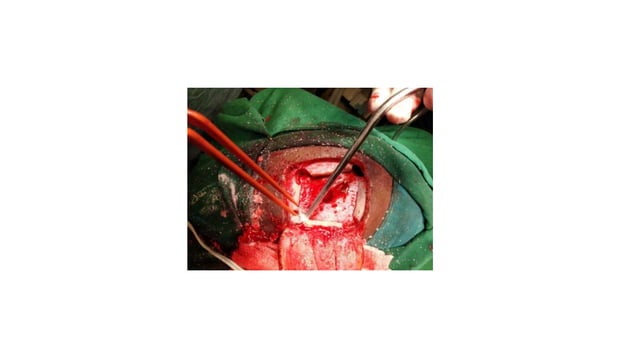 Colloid cyst pre operative session | PPTX