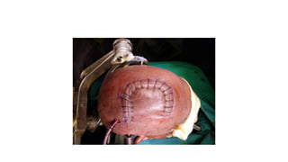 Colloid cyst pre operative session | PPTX