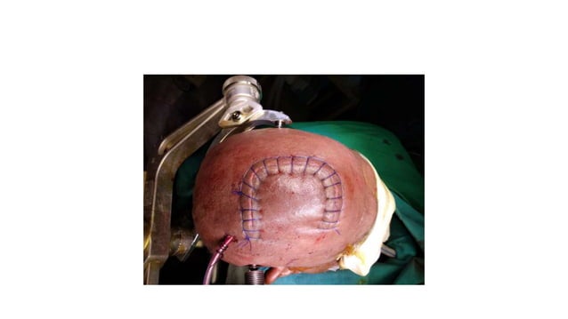 Colloid cyst pre operative session | PPTX