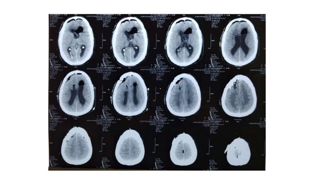 Colloid cyst pre operative session | PPTX