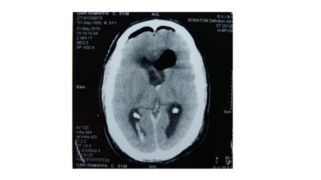 Colloid cyst pre operative session | PPTX