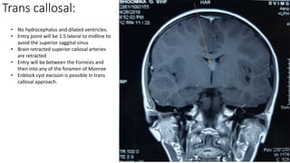 Colloid cyst pre operative session | PPTX
