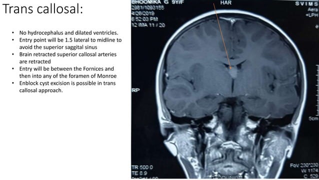 Colloid cyst pre operative session | PPTX