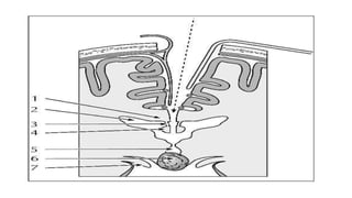Colloid cyst pre operative session | PPTX