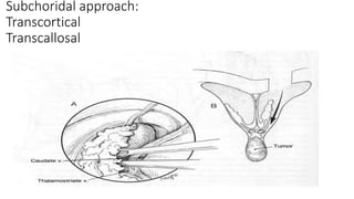 Colloid cyst pre operative session | PPTX