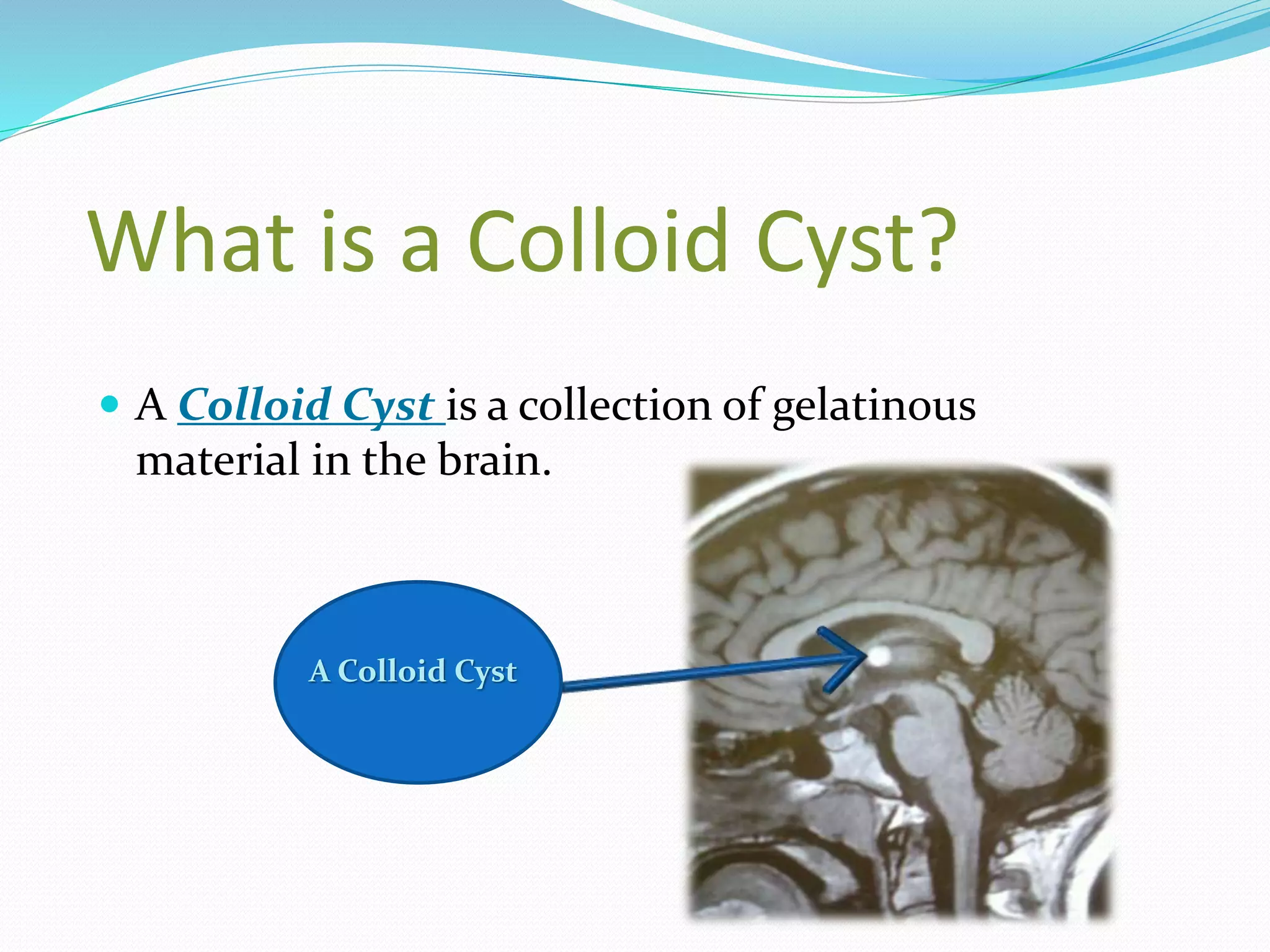 Colloid cysts | PPT