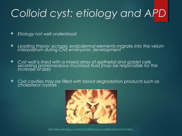 Symptomatical colloid cyst_Torfs | PPT