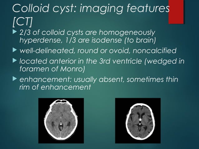 Symptomatical colloid cyst_Torfs | PPT