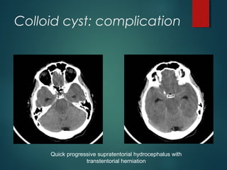 Symptomatical colloid cyst_Torfs | PPT
