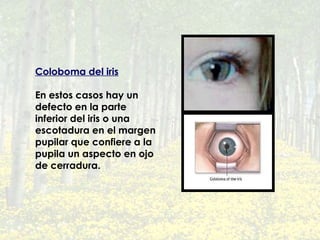 Coloboma | PPT