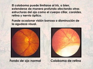 Coloboma | PPT