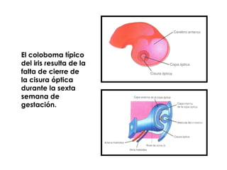 Coloboma | PPT