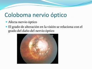 Coloboma congenito y desarrollo embriologico del ojo | PPTX