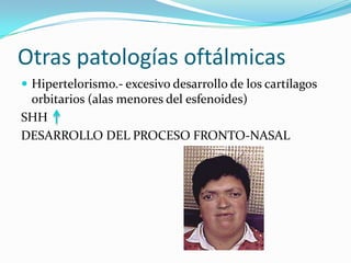 Coloboma congenito y desarrollo embriologico del ojo | PPTX