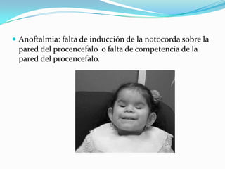 Coloboma congenito y desarrollo embriologico del ojo | PPTX