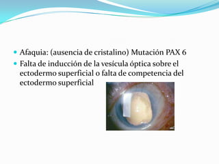 Coloboma congenito y desarrollo embriologico del ojo | PPTX