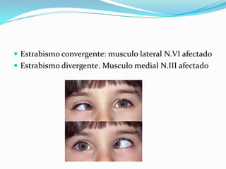 Coloboma congenito y desarrollo embriologico del ojo | PPTX