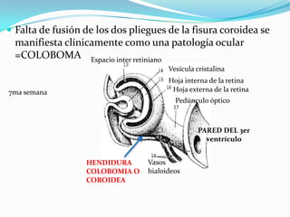 Coloboma congenito y desarrollo embriologico del ojo | PPTX