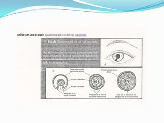 Coloboma congenito y desarrollo embriologico del ojo | PPTX