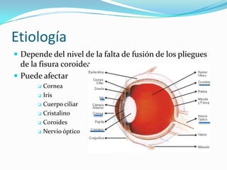 Coloboma congenito y desarrollo embriologico del ojo | PPTX