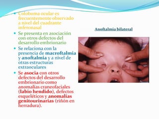 Coloboma congenito y desarrollo embriologico del ojo | PPTX