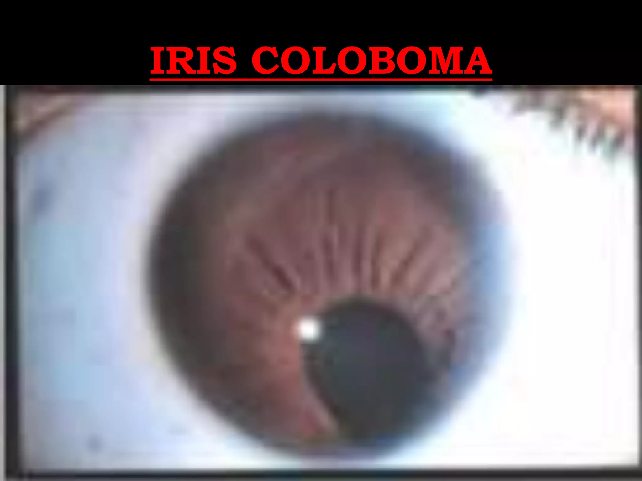Coloboma | PPTX