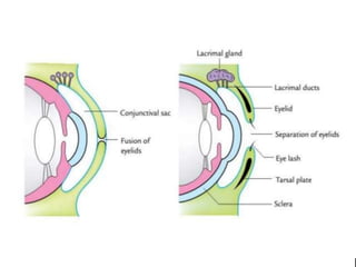 Coloboma | PPTX