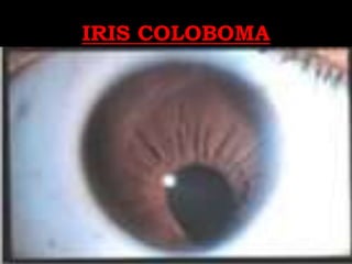 Coloboma Of The Eye