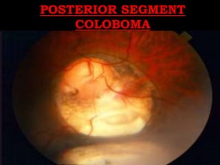 Posterior Coloboma