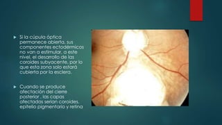Coloboma del nervio optico( segmento posterior | PPTX