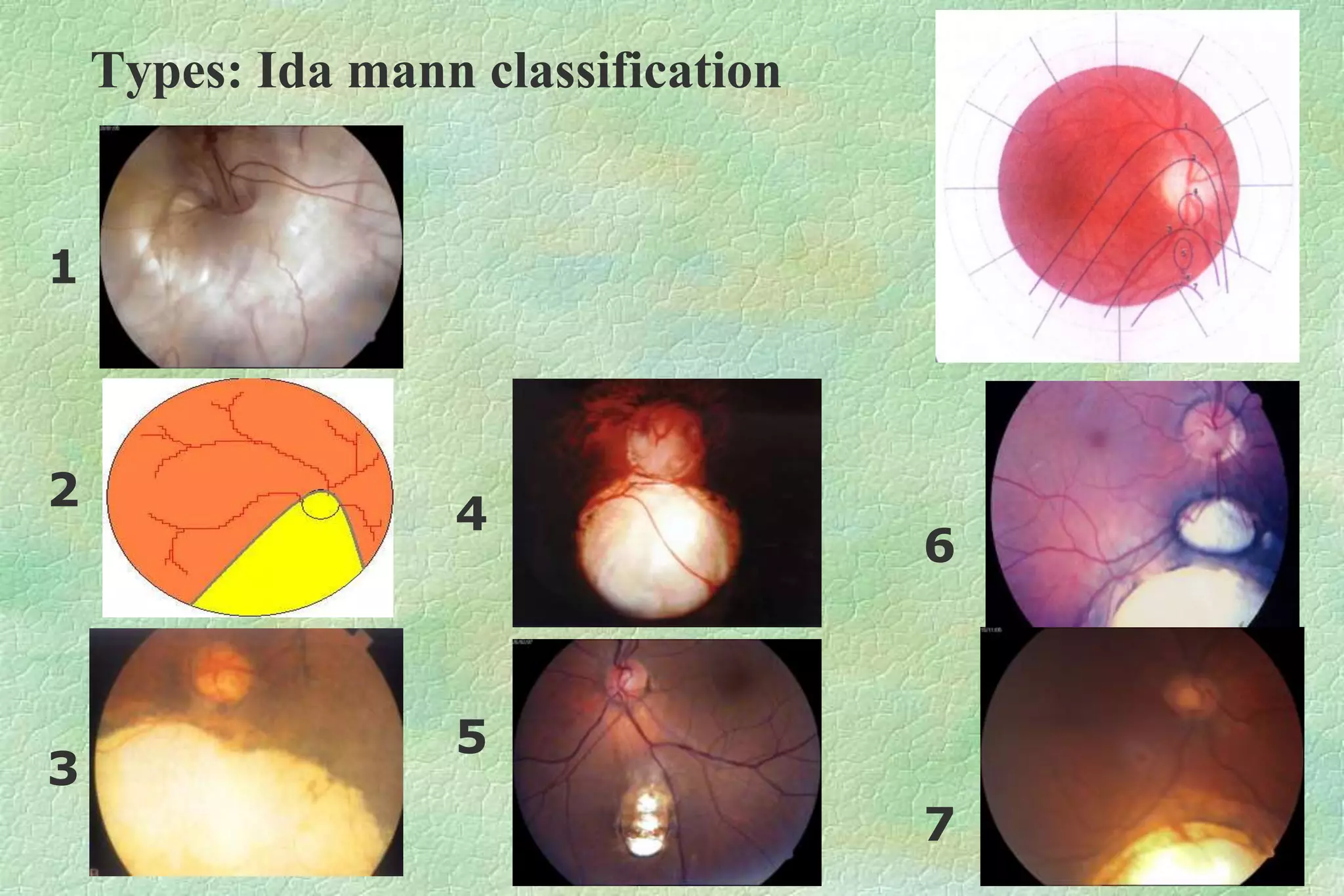 Coloboma | PPTX