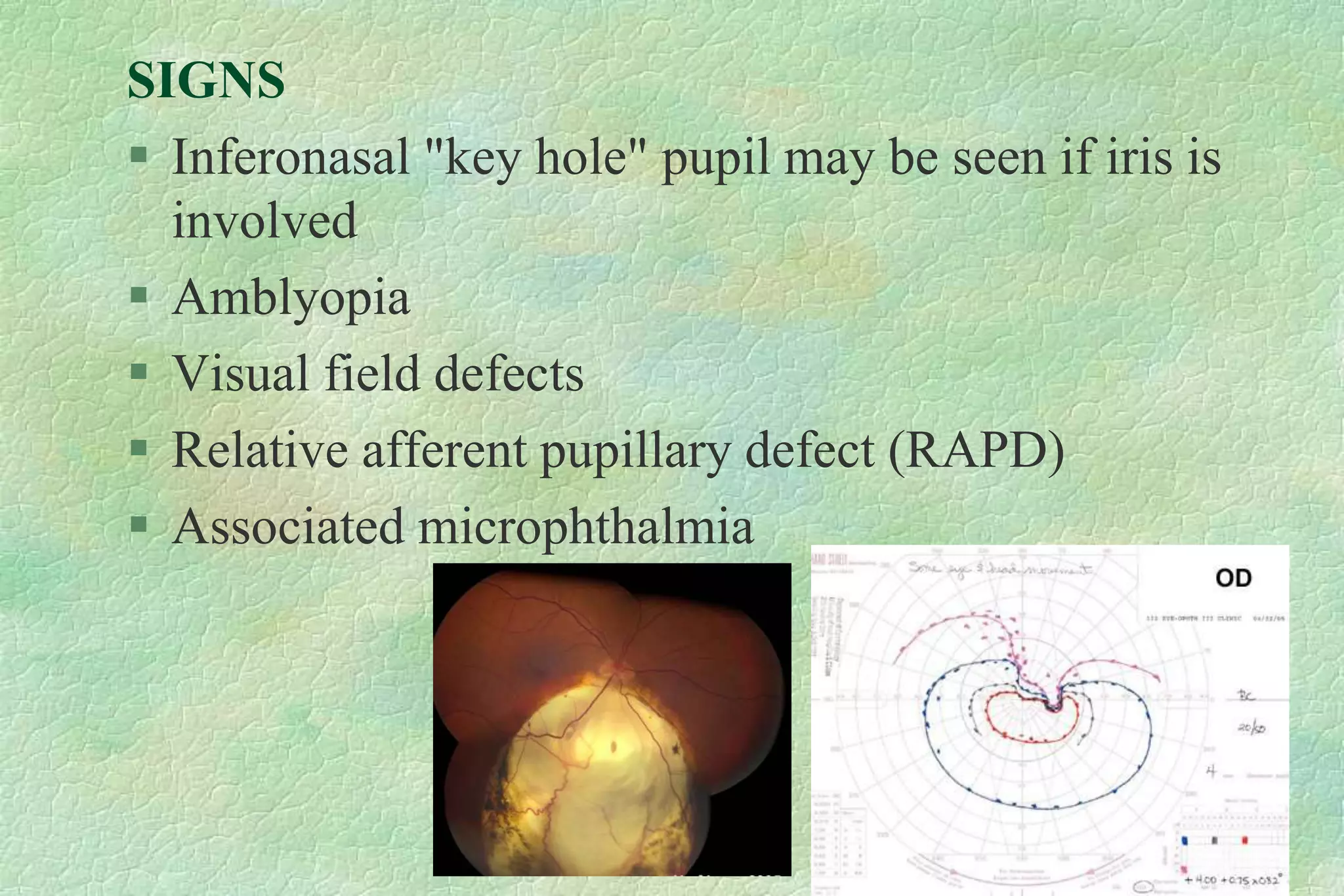 Coloboma | PPTX