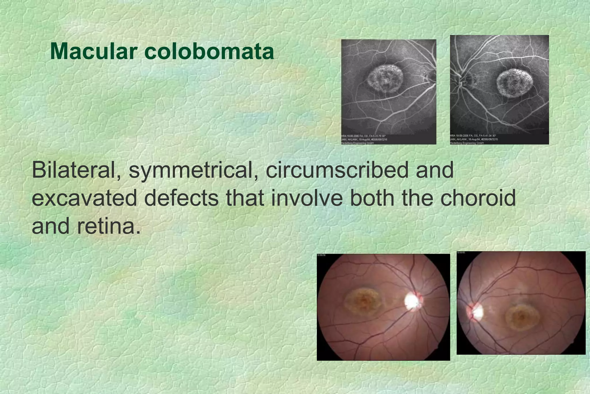 Coloboma | PPTX