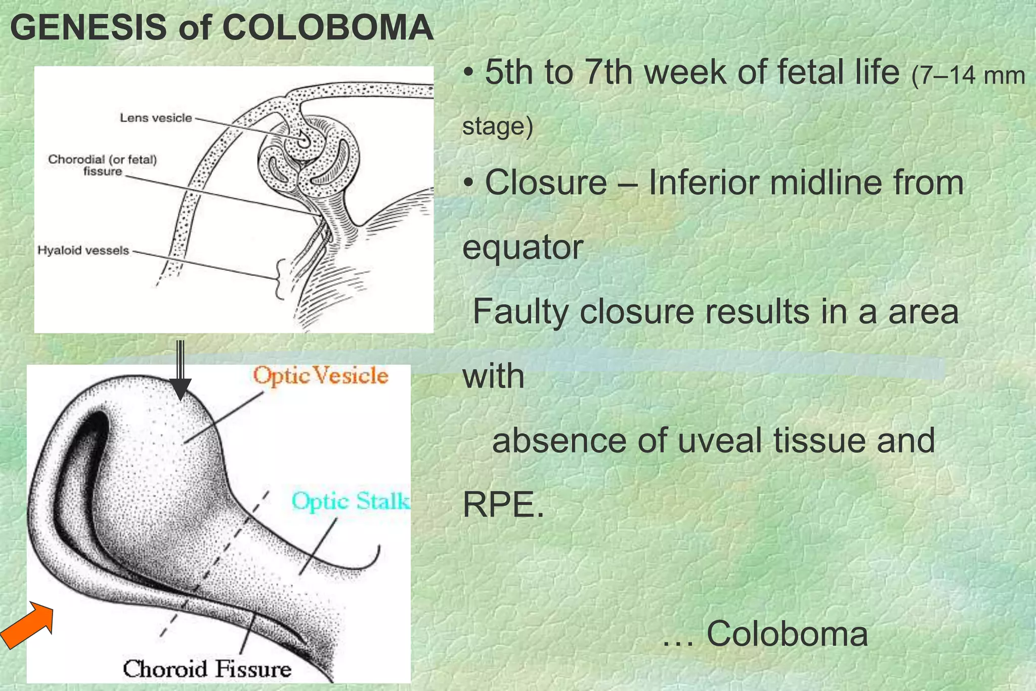 Coloboma | PPTX