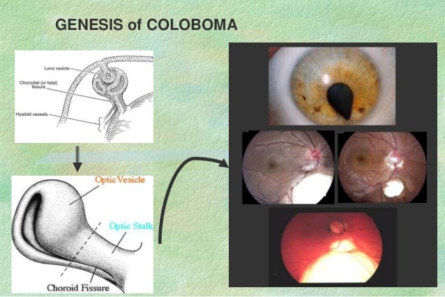 Coloboma