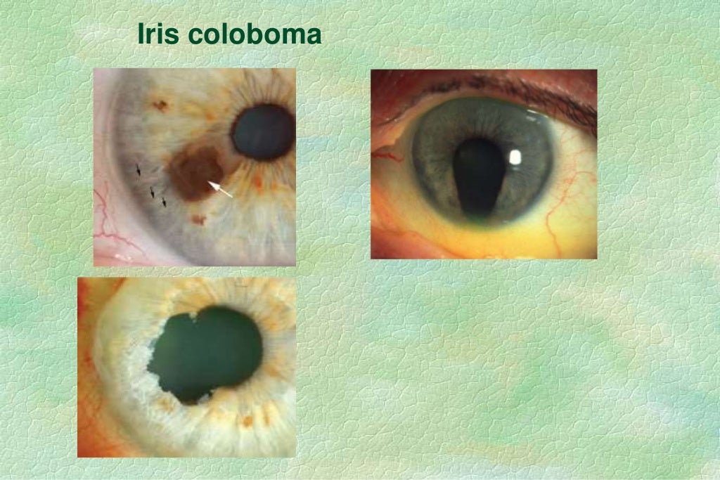 Coloboma