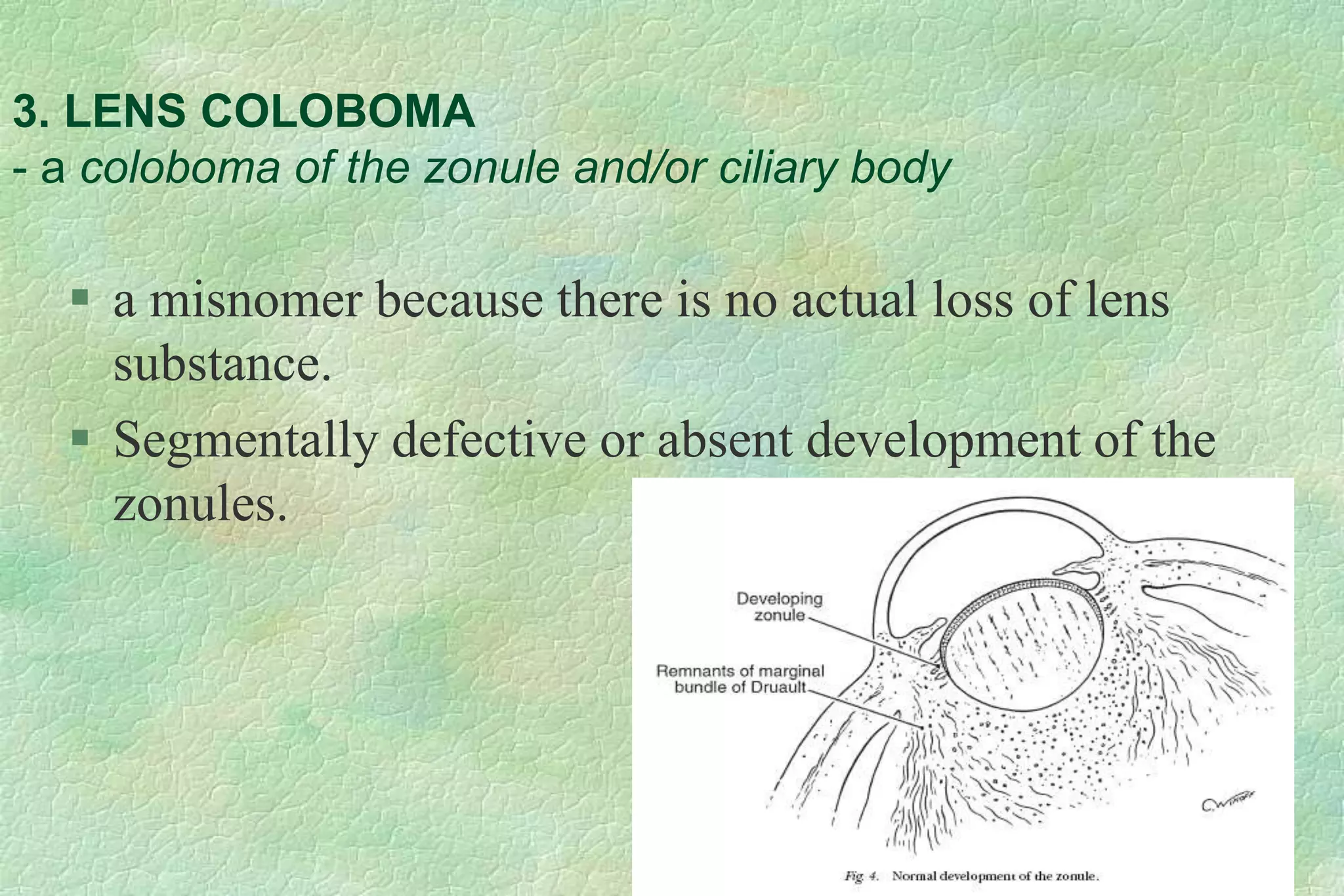 Coloboma | PPTX