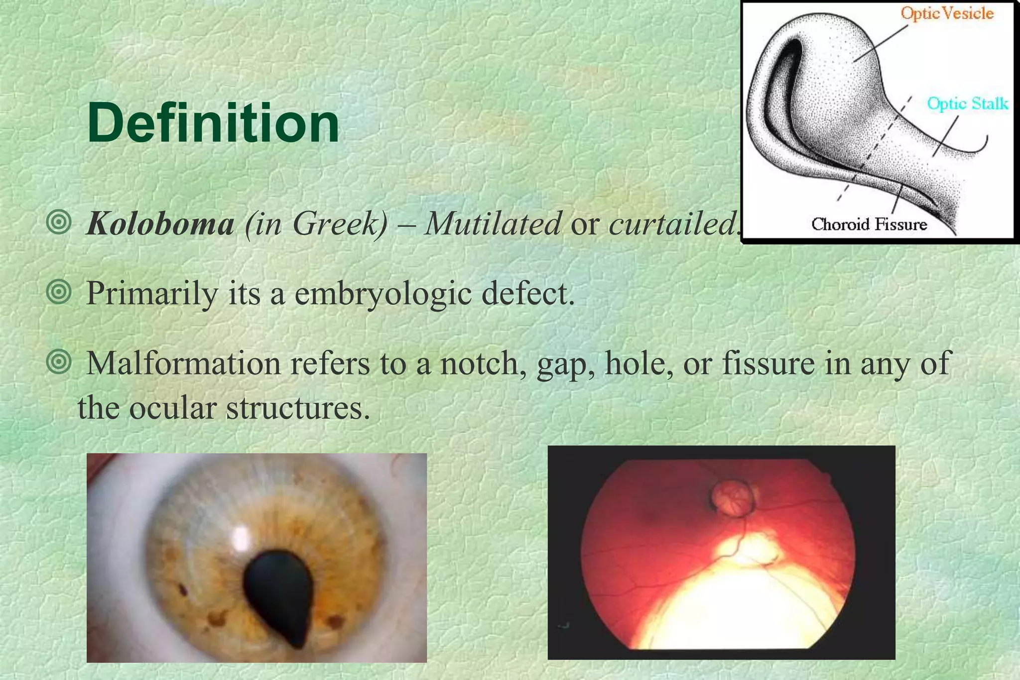 Coloboma | PPT