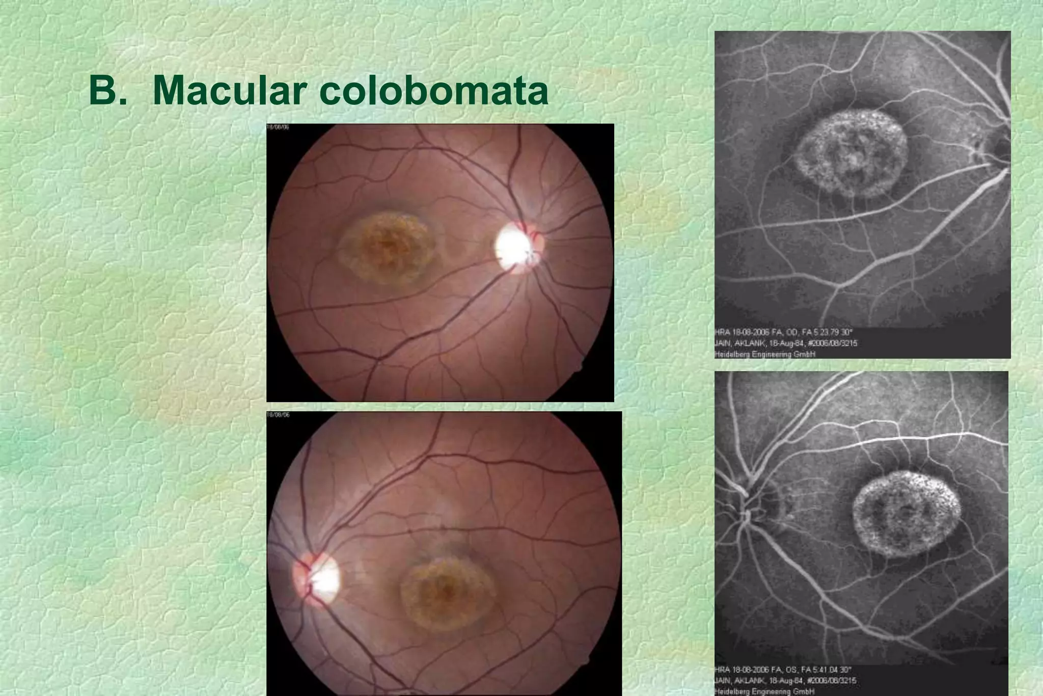 Coloboma | PPTX