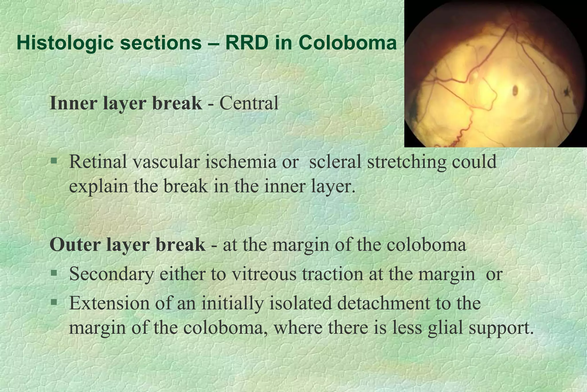 Coloboma | PPTX