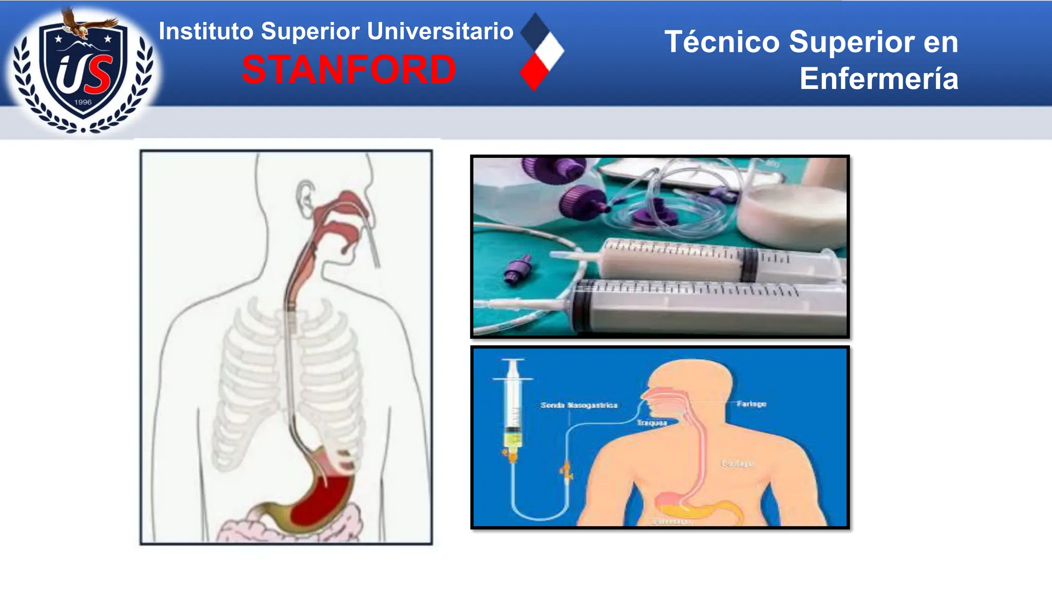 Colocación De La Sonda Nasogastrica Pdf